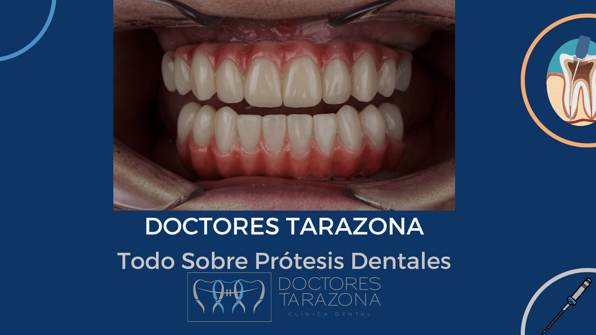 Todo Sobre Prótesis Dentales – Sonrisas Perfectas | Clínica Dental ...
